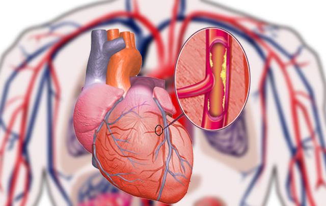 hipertension: noviembre 2016