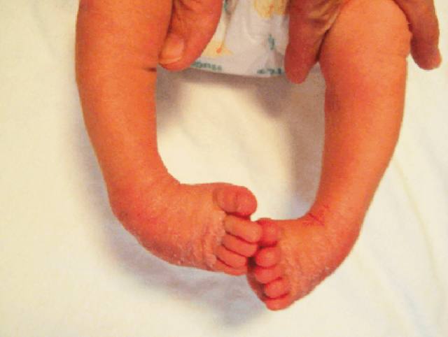 ¿Qué hacer si mi hijo tiene pie bot? - Sanatorio Allende 2017 - Cadena ...